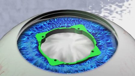 Iris retractoren | Medical Workshop